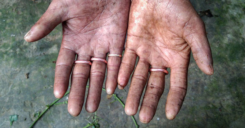 The Family Born With No Fingerprints » TwistedSifter