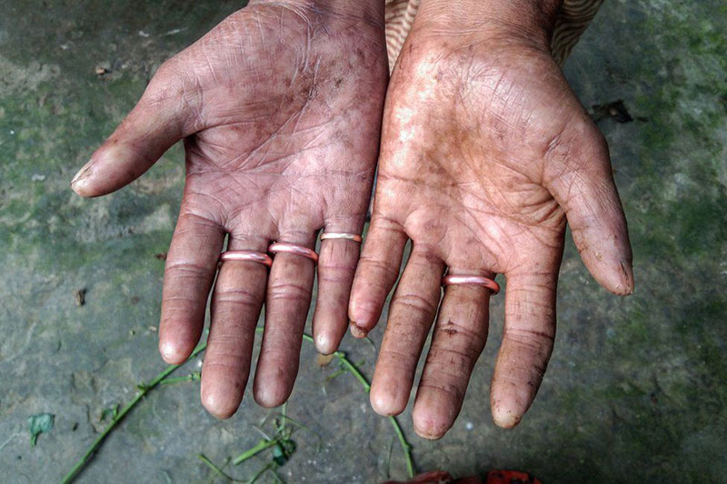 The Family Born With No Fingerprints » TwistedSifter