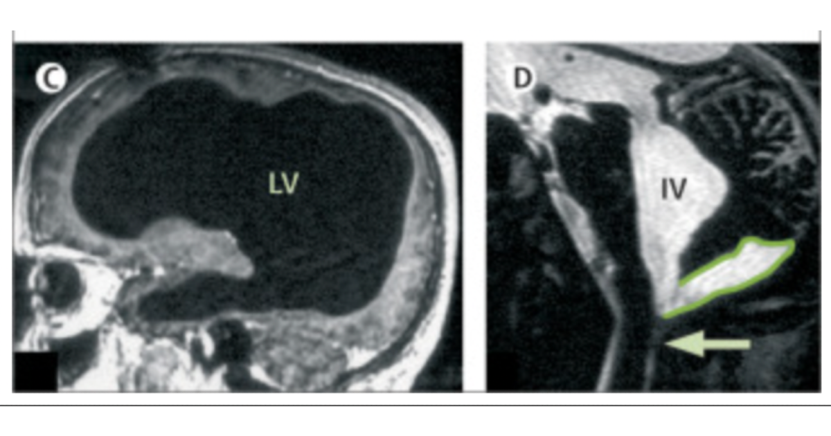What We Can Learn About Human Consciousness From A Man Missing Most Of ...