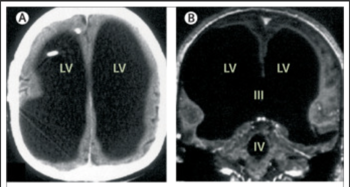 What We Can Learn About Human Consciousness From A Man Missing Most Of ...
