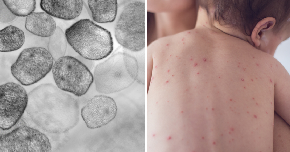 Why Scientists Are Concerned About The Re-Emergence Of One Of The World ...