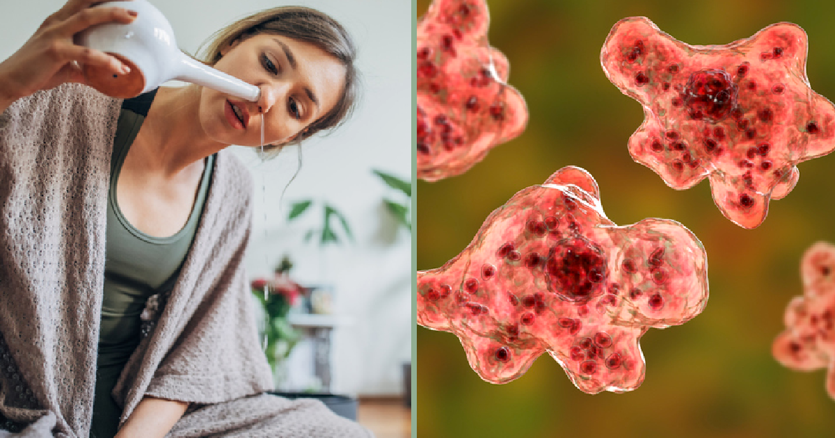 Washing Your Sinuses With Tap Water Could Be Fatal. Here’s How To Make ...