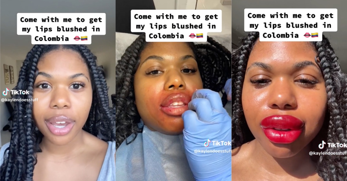 A Woman’s Lip Treatment Fail Went Viral And We Definitely Feel For Her ...